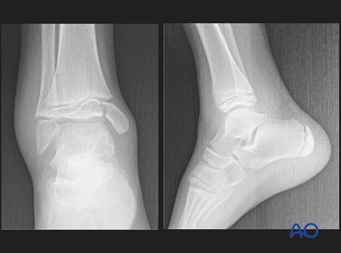 Epiphyseal fractures (Salter-Harris III) of the distal tibia