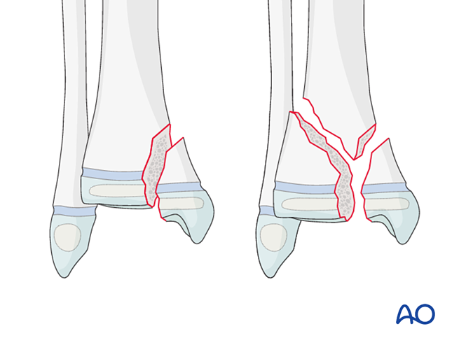 Epi-/metaphyseal fractures (Salter-Harris IV) of the distal tibia