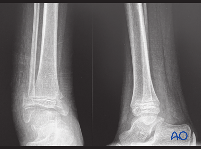 Epi-/metaphyseal fractures (Salter-Harris IV) of the distal tibia