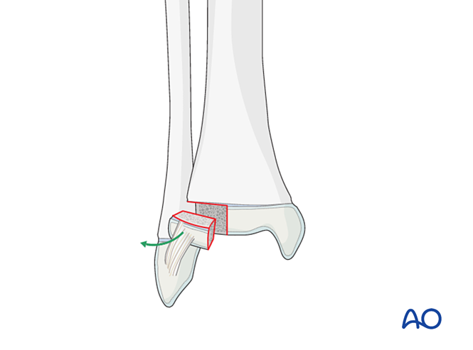 Anterolateral epiphyseal fractures of the distal tibia (Tillaux)