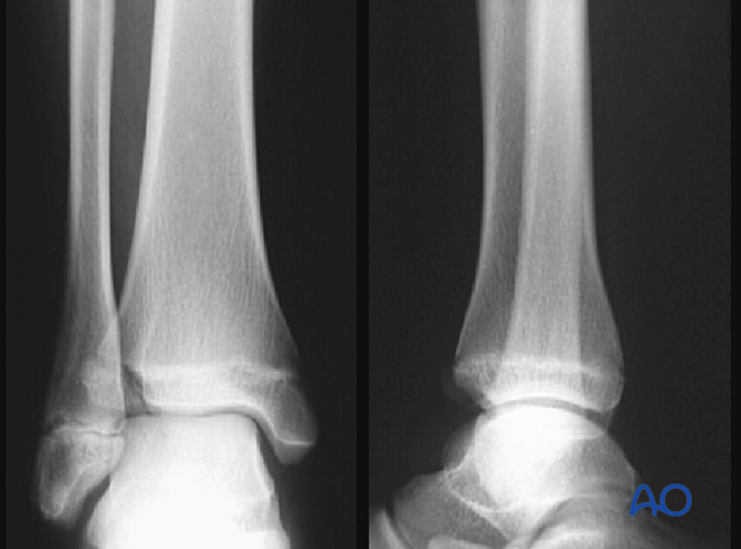 Anterolateral epiphyseal fractures of the distal tibia (Tillaux)