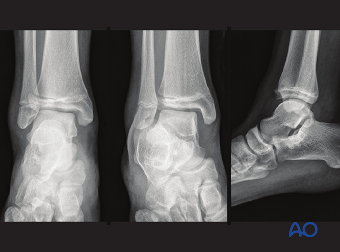 Anterolateral epiphyseal fractures of the distal tibia (Tillaux)