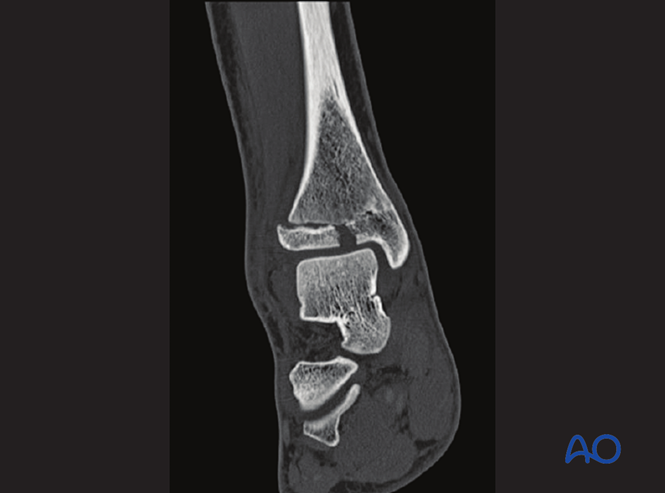 Open reduction; screw fixation for Anterolateral epiphyseal fractures ...