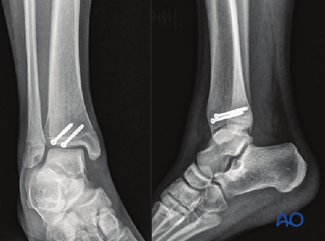 Open reduction; screw fixation for Anterolateral epiphyseal fractures ...