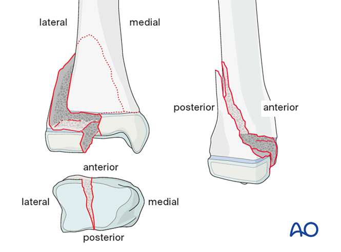 Complex epi-/metaphyseal fractures of the distal tibia (triplane)