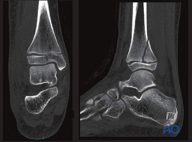 Complex epi-/metaphyseal fractures of the distal tibia (triplane)