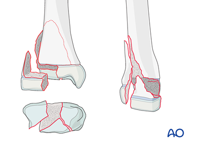 Complex epi-/metaphyseal fractures of the distal tibia (triplane)