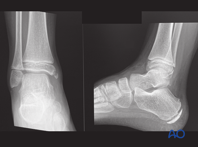 Avulsion fractures of the medial malleolus
