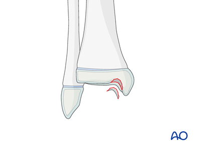 Osteochondral fractures (intraarticular flake) of the distal tibia