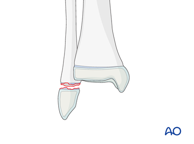 Epiphysiolysis (Salter-Harris I and II) of the distal fibula