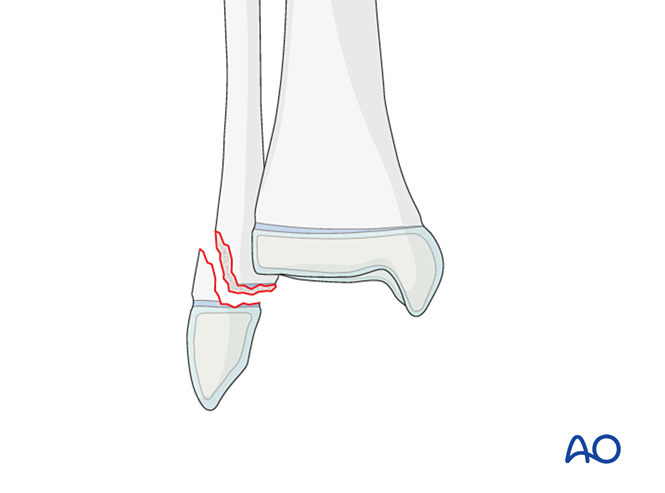 Epiphysiolysis (Salter-Harris I and II) of the distal fibula