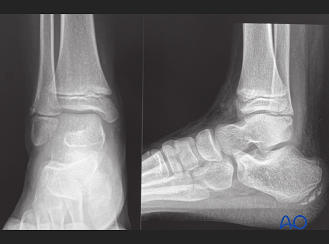 Epiphysiolysis (Salter-Harris I and II) of the distal fibula