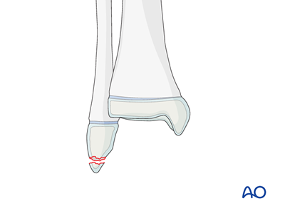Avulsion fractures of the distal fibula