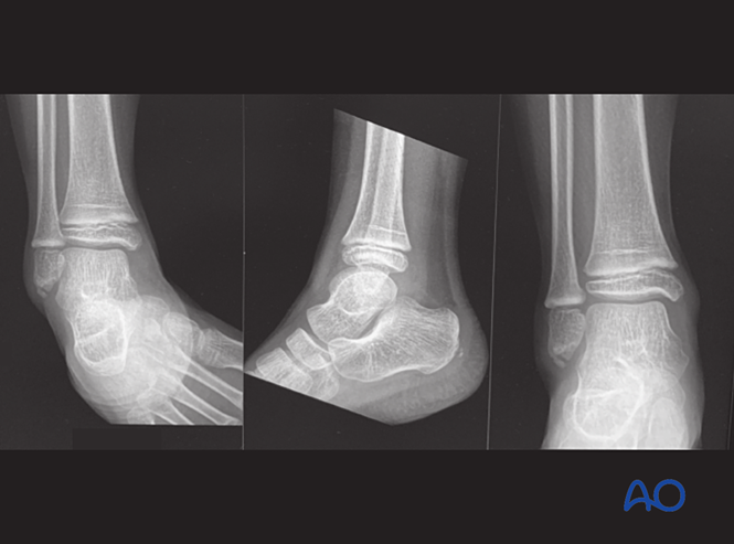 Avulsion fractures of the distal fibula