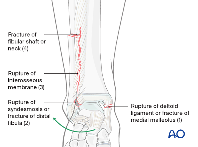 Syndesmotic injuries
