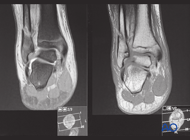 Syndesmotic transfixation with suture and button (suspensory fixation ...