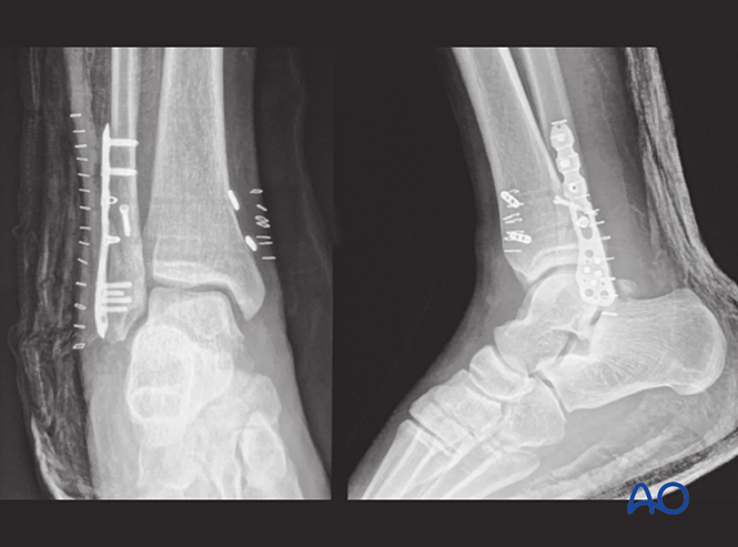 Syndesmotic transfixation with suture and button (suspensory fixation ...