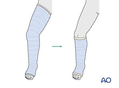 Short leg cast for Epiphysiolysis (Salter-Harris I) of the distal tibia