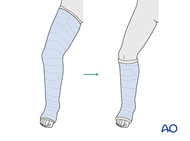 Closed reduction; short leg cast for Complete fractures of the distal ...