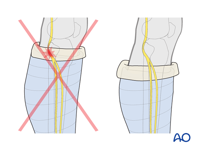 Short leg cast for Simple complete fracture of the distal tibial metaphysis
