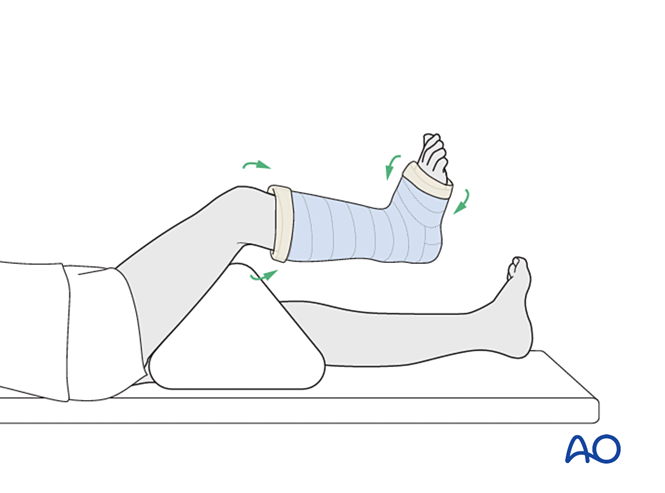 Short leg cast for Epiphysiolysis (Salter-Harris I) of the distal tibia
