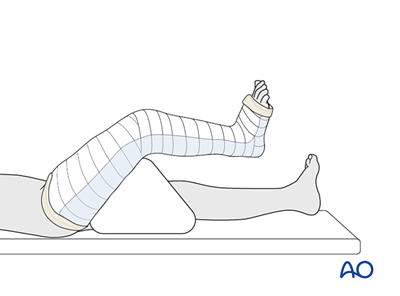 Long leg cast for Epiphyseal fractures (Salter-Harris III) of the ...