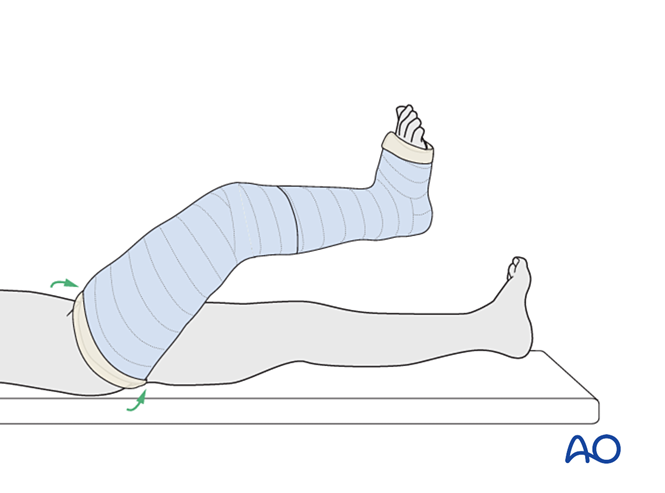 Long leg cast