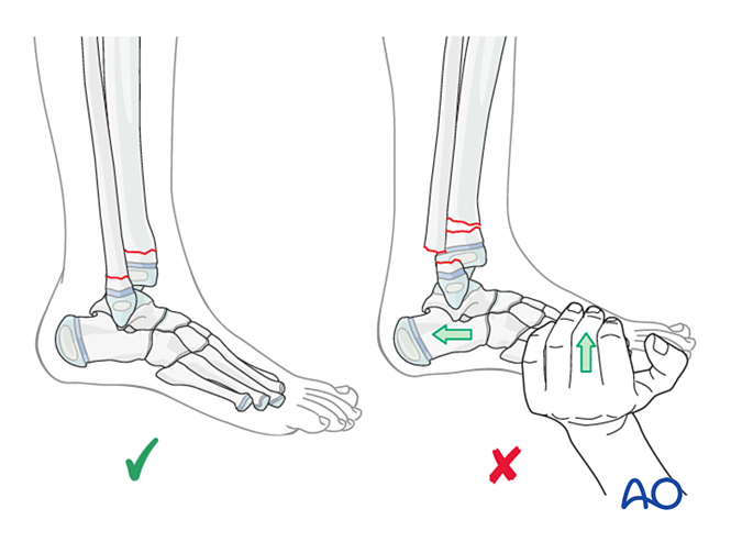 Closed reduction; K-wire fixation for Simple complete fracture of the ...