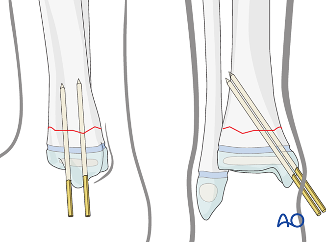 Closed reduction; K-wire fixation for Simple complete fracture of the ...