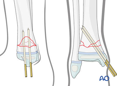 Closed reduction; K-wire fixation for Multifragmentary complete ...