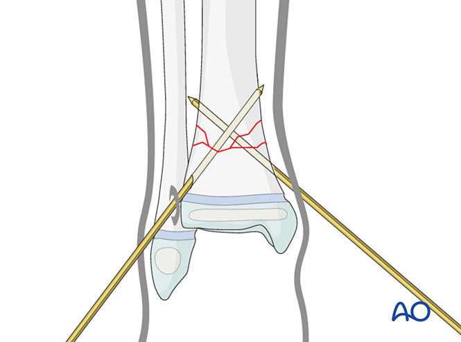 Closed reduction; K-wire fixation for Multifragmentary complete ...