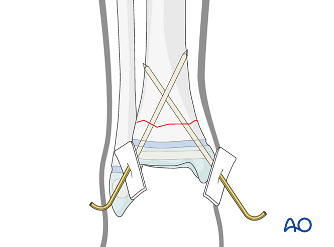 Closed reduction; K-wire fixation for Simple complete fracture of the ...