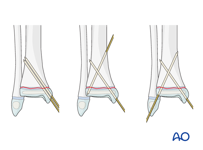 Closed reduction; K-wire fixation for Epiphysiolysis (Salter-Harris I ...