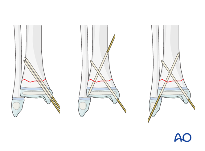 Closed reduction; K-wire fixation for Simple complete fracture of the ...