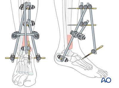 External fixation for Simple complete fracture of the distal tibial ...