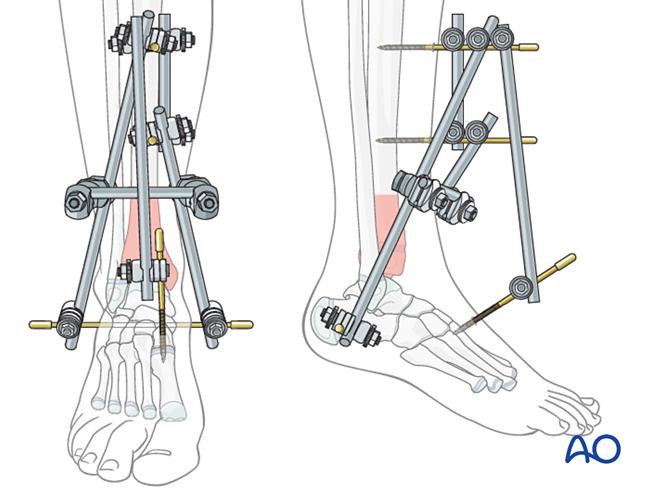 External fixation for Simple complete fracture of the distal tibial ...