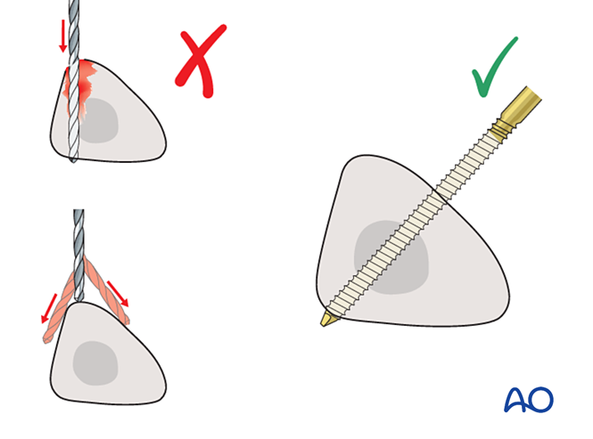 External fixation for Simple complete fracture of the distal tibial ...