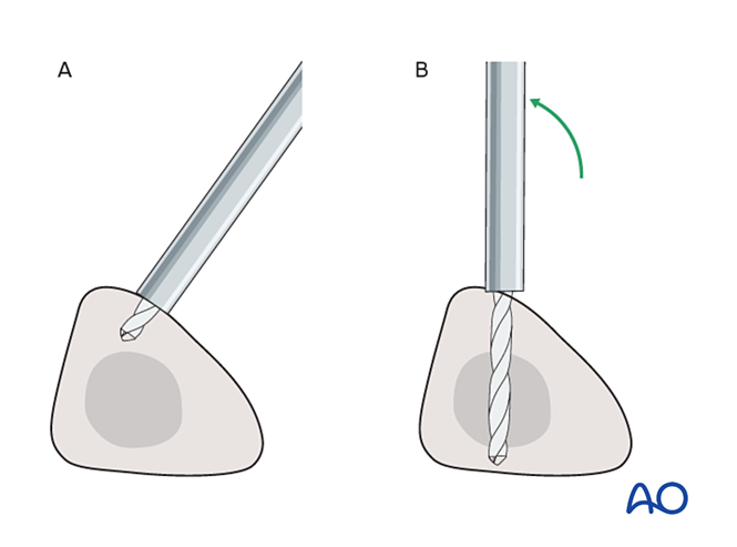External fixation for Simple complete fracture of the distal tibial ...