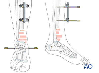 External fixation for Complex epi-/metaphyseal fractures of the distal ...