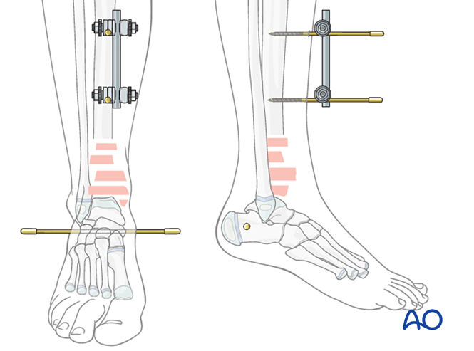 External fixation for Simple complete fracture of the distal tibial ...