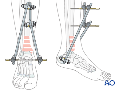 External fixation for Simple complete fracture of the distal tibial ...