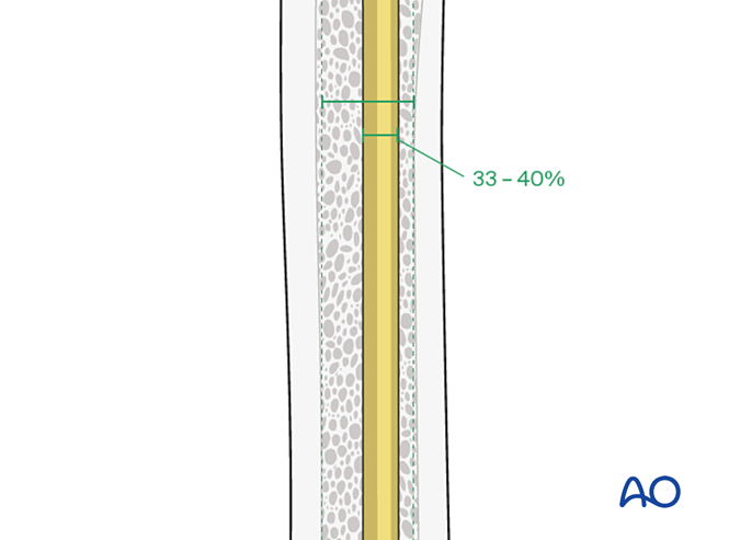 Elastic nailing for Multifragmentary complete fracture of the distal ...