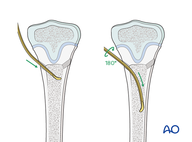Elastic nailing for Simple complete fracture of the distal tibial ...