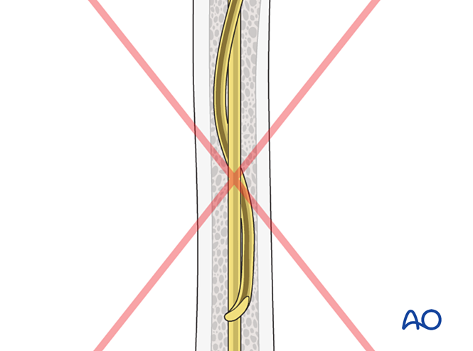 Elastic nailing for Simple complete fracture of the distal tibial ...