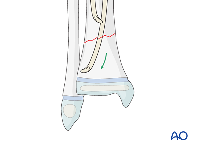 Elastic nailing for Simple complete fracture of the distal tibial ...
