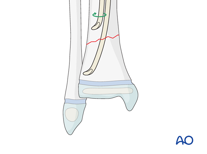 Elastic nailing for Simple complete fracture of the distal tibial ...