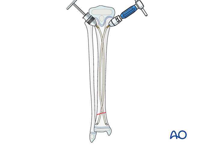Elastic nailing for Simple complete fracture of the distal tibial ...