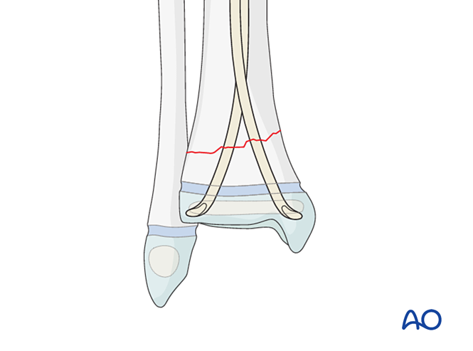 Elastic nailing for Simple complete fracture of the distal tibial ...