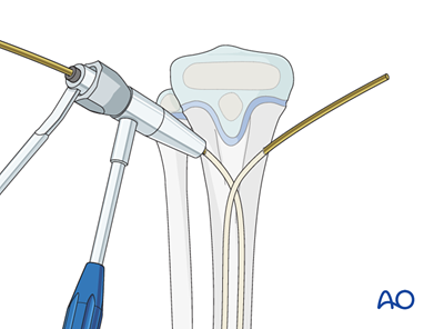 Elastic nailing for Simple complete fracture of the distal tibial ...