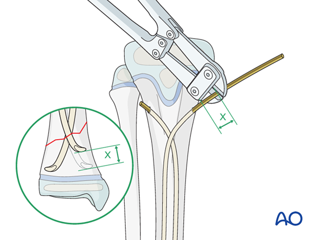 Elastic nailing for Simple complete fracture of the distal tibial ...